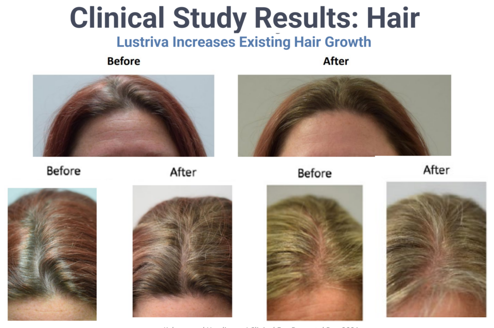 Force Factor Hair Growth Accelerator Chews and Capsules Feature ...